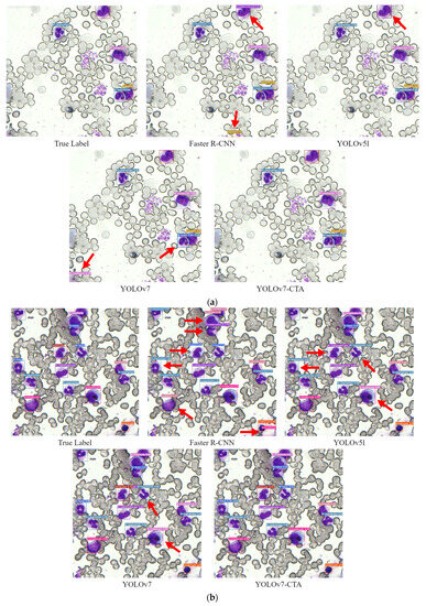 Improved YOLOv7 Algorithm for Detecting Bone Marrow Cells