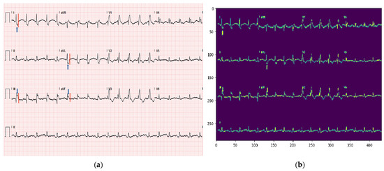 Efficient Classification of ECG Images Using a Lightweight CNN with Attention Module and IoT