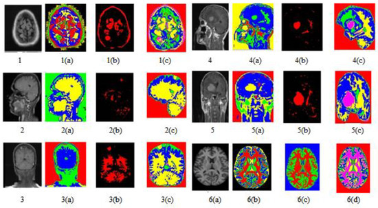 Sensors | Free Full-Text | An Efficient Brain Tumor Segmentation Method Based on Adaptive Moving ...