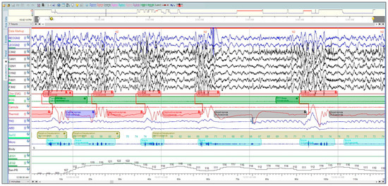Home Sleep Study Cpt Code 2017 - Homemade Ftempo