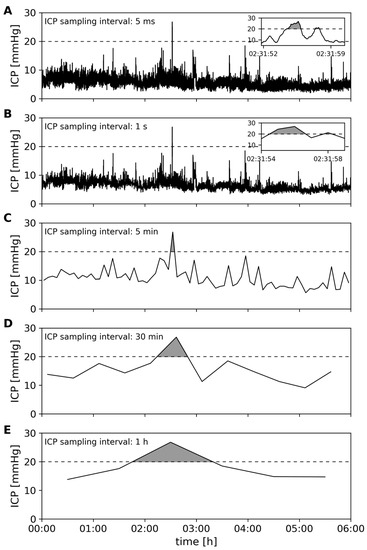 Pressure Time Dose as a Representation of Intracranial Pressure Burden ...