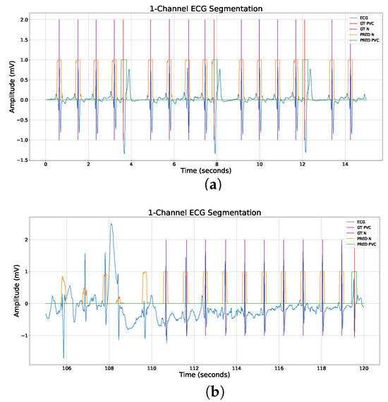 Sensors | Free Full-Text | End-to-End Premature Ventricular Contraction ...