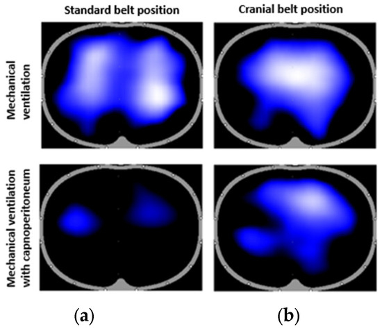 Cranial Electrode Belt Position Improves Diagnostic Possibilities of ...