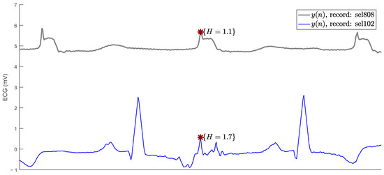 Fast Parabolic Fitting: An R-Peak Detection Algorithm for Wearable ECG Devices