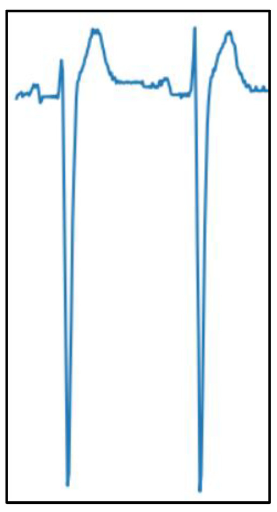 Artificial Intelligence ECG Analysis in Patients with Short QT Syndrome ...