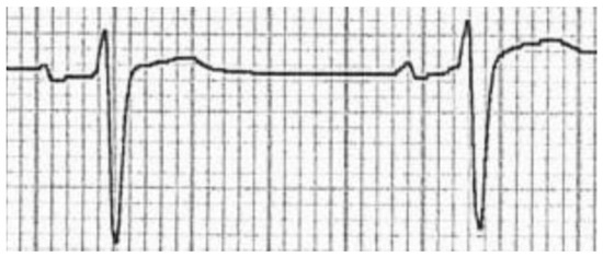 Artificial Intelligence ECG Analysis in Patients with Short QT Syndrome ...