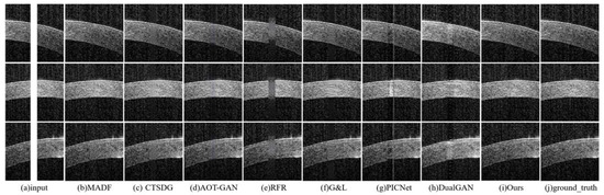 Inpainting Saturation Artifact in Anterior Segment Optical Coherence ...