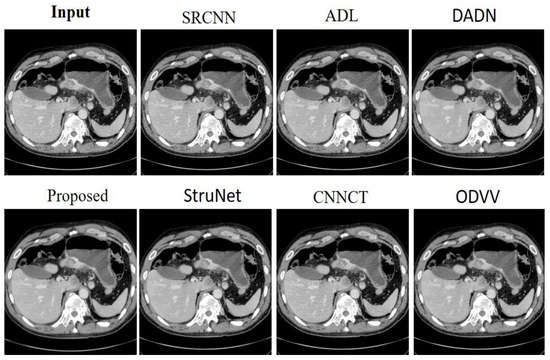 Enhancing Medical Image Denoising with Innovative Teacher–Student Model ...