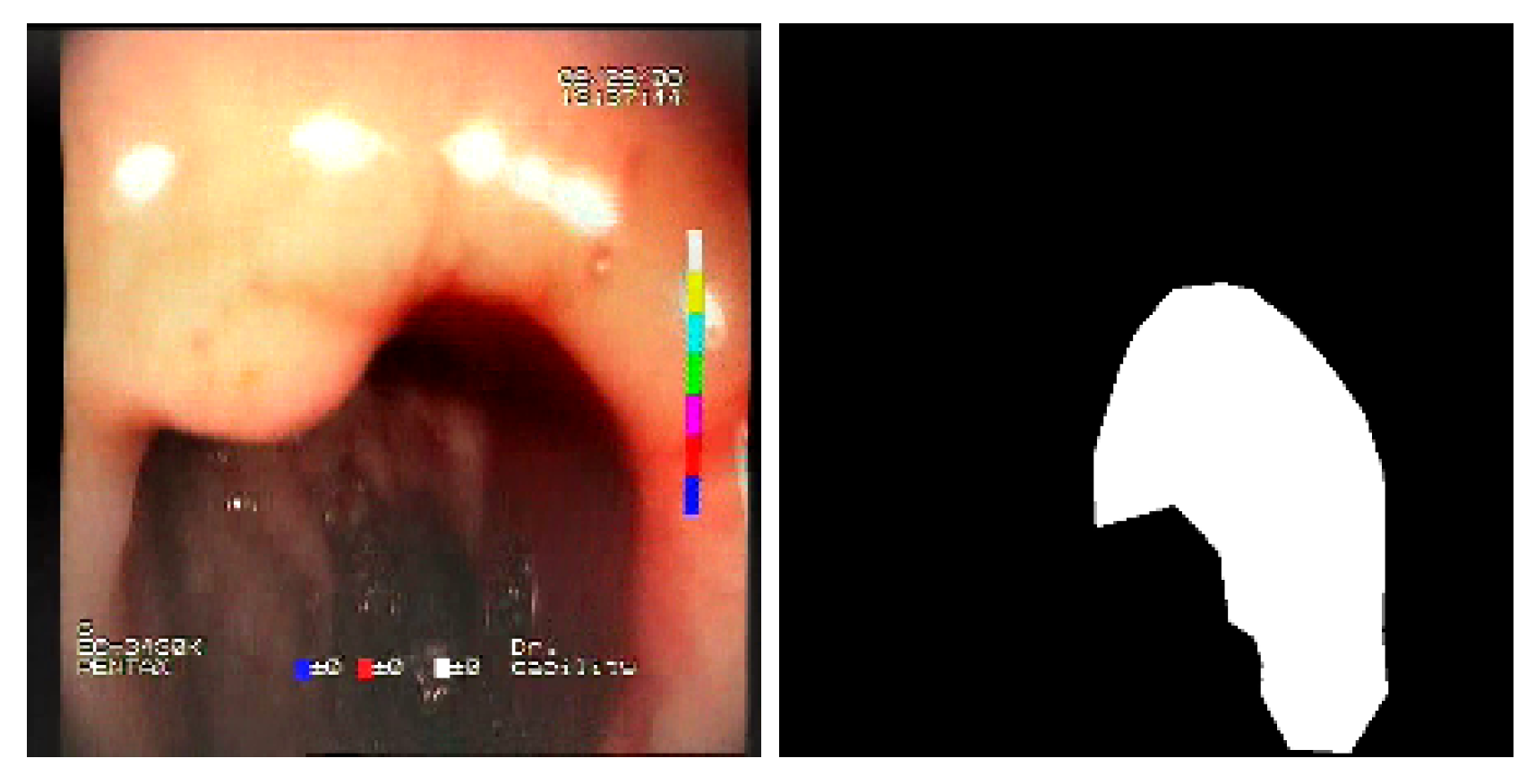 Visual Features for Improving Endoscopic Bleeding Detection Using Convolutional Neural Networks