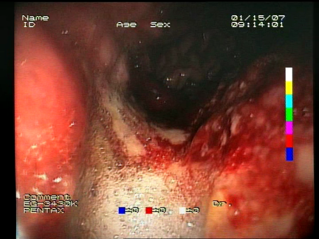 Visual Features for Improving Endoscopic Bleeding Detection Using Convolutional Neural Networks