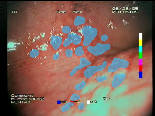 Visual Features for Improving Endoscopic Bleeding Detection Using Convolutional Neural Networks