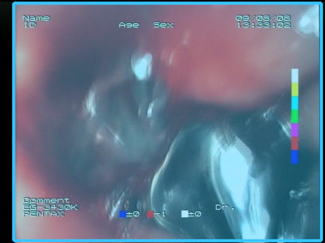 Visual Features for Improving Endoscopic Bleeding Detection Using Convolutional Neural Networks