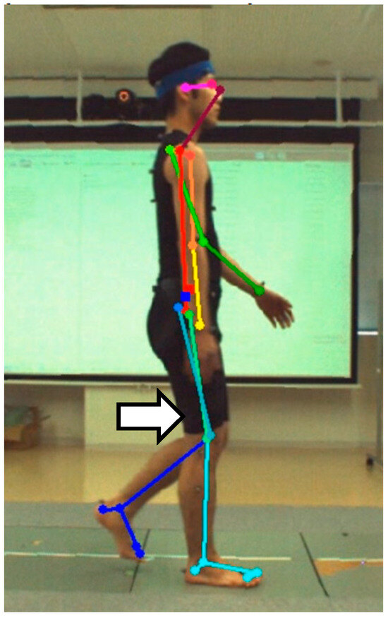 Validity of AI-Based Gait Analysis for Simultaneous Measurement of ...