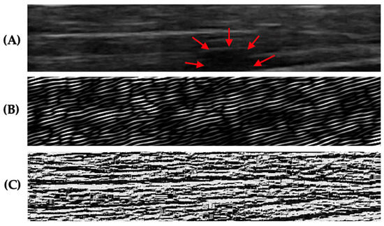 Identification of Myofascial Trigger Point Using the Combination of ...