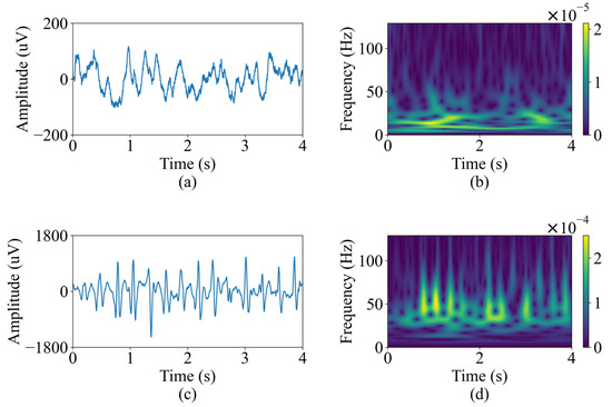 Automatic Seizure Detection Based on Stockwell Transform and Transformer