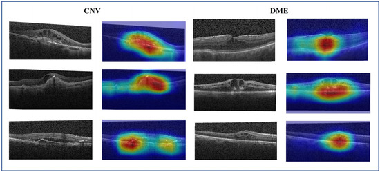 Multi-Scale-Denoising Residual Convolutional Network for Retinal Disease Classification Using OCT