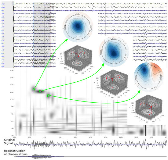 Sensors | Free Full-Text | Two-Stage Atomic Decomposition of Multichannel EEG and the Previously ...