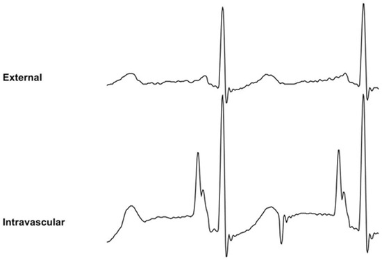 Comparison of ECG Saline-Conduction Technique and ECG Wire-Based ...