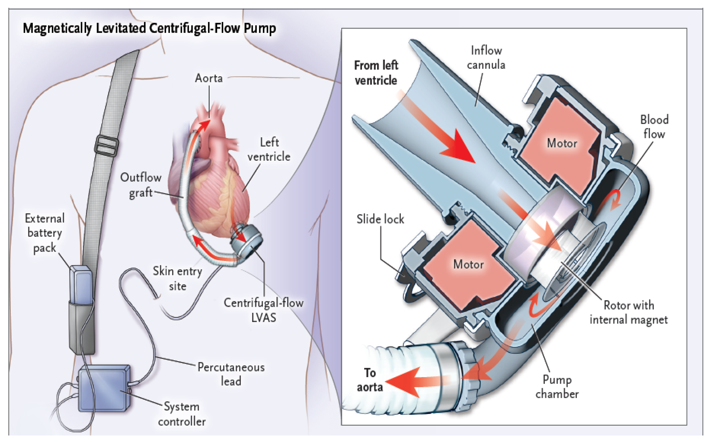Ventricular Arrhythmias in Left Ventricular Assist Device Patients—Current Diagnostic and ...