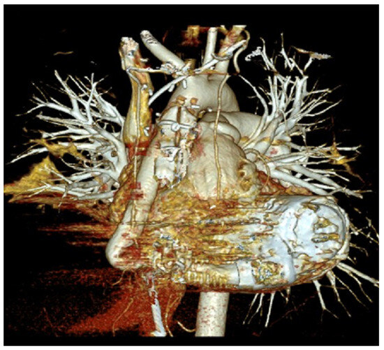 Ventricular Arrhythmias in Left Ventricular Assist Device Patients ...