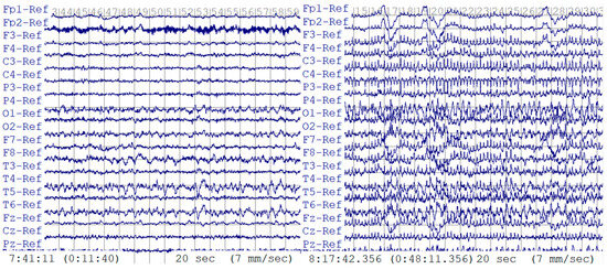 Automated Seizure Detection Based on State-Space Model Identification