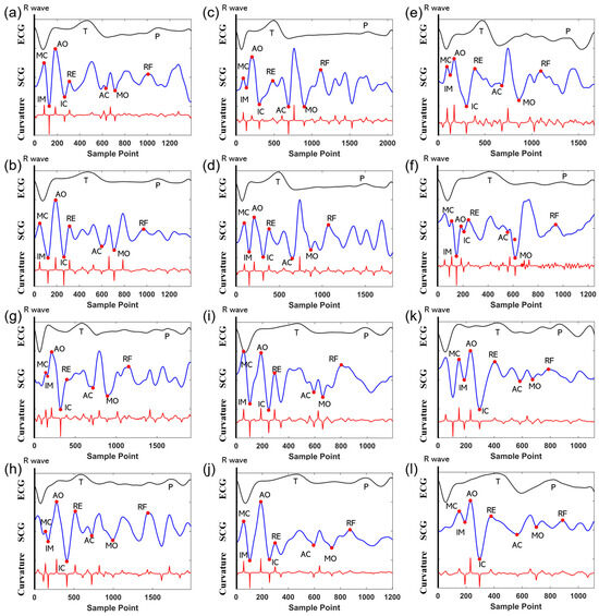 Cardiac Multi-Frequency Vibration Signal Sensor Module and Feature Extraction Method Based on ...