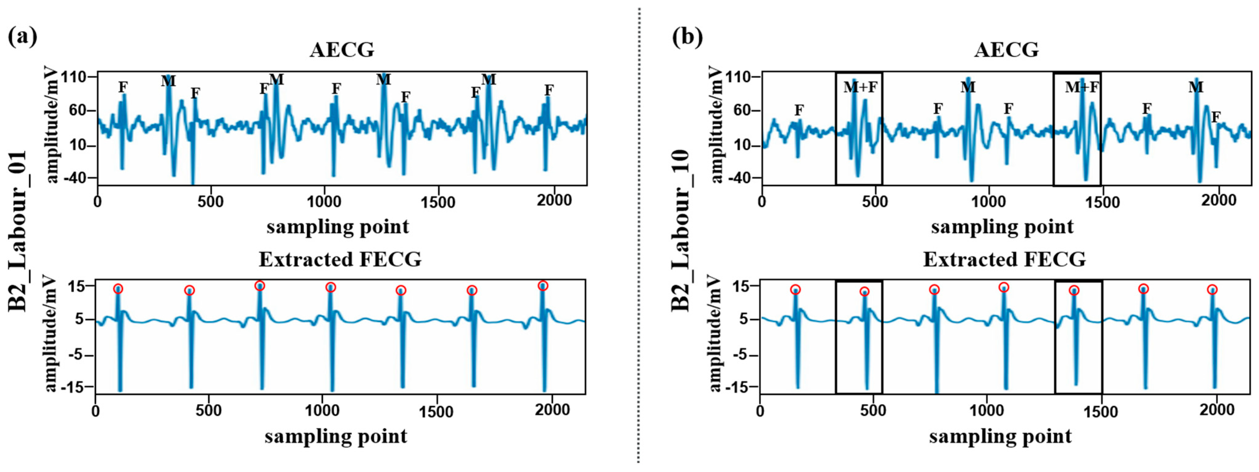 Enhancing Fetal Electrocardiogram Signal Extraction Accuracy through a CycleGAN Utilizing ...