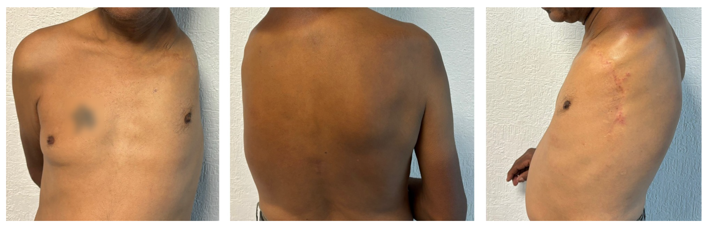 Embedded Machine Learning System for Muscle Patterns Detection in a ...