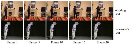 FP-GCN: Frequency Pyramid Graph Convolutional Network for Enhancing Pathological Gait Classification