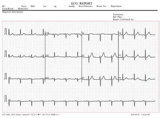 Characterization of Heart Diseases per Single Lead Using ECG Images and ...