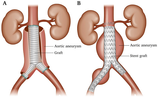 Implantable Pressure-Sensing Devices for Monitoring Abdominal Aortic Aneurysms in Post ...