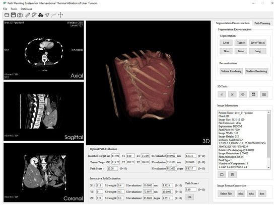 Design of Path-Planning System for Interventional Thermal Ablation of ...