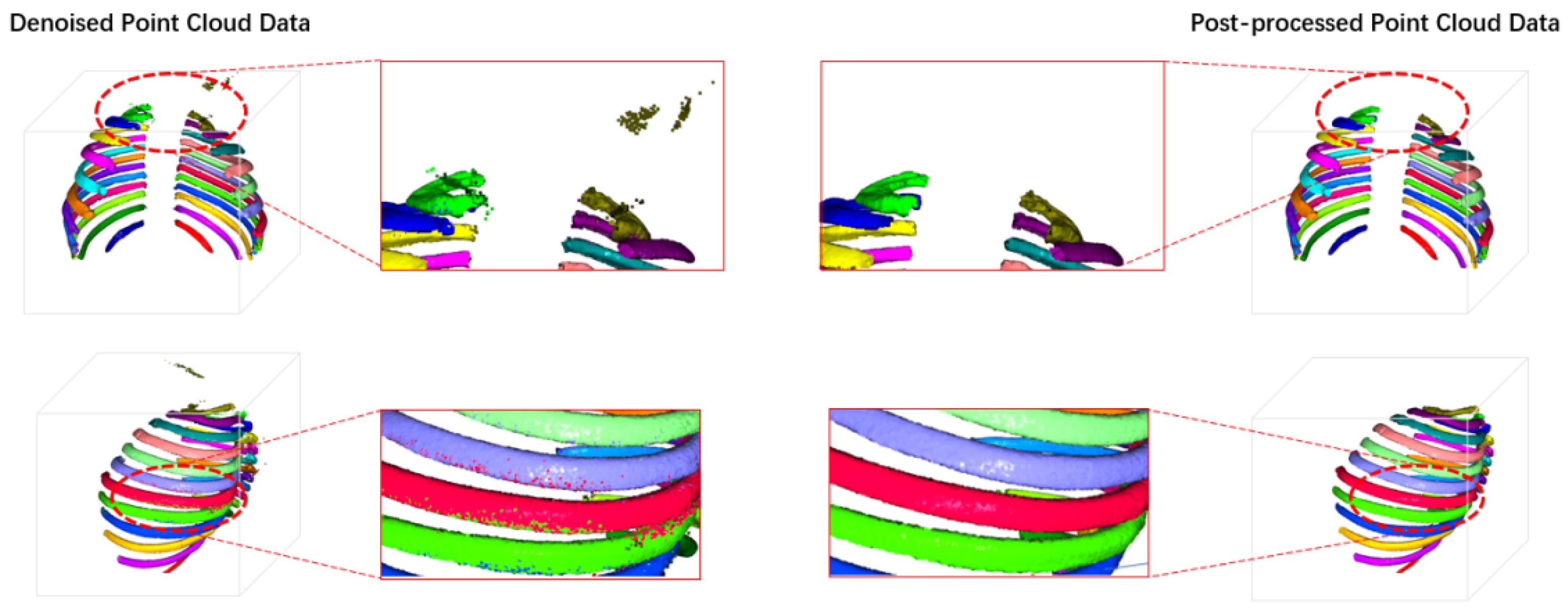 Research on Three-Dimensional Reconstruction of Ribs Based on Point Cloud Adaptive Smoothing ...