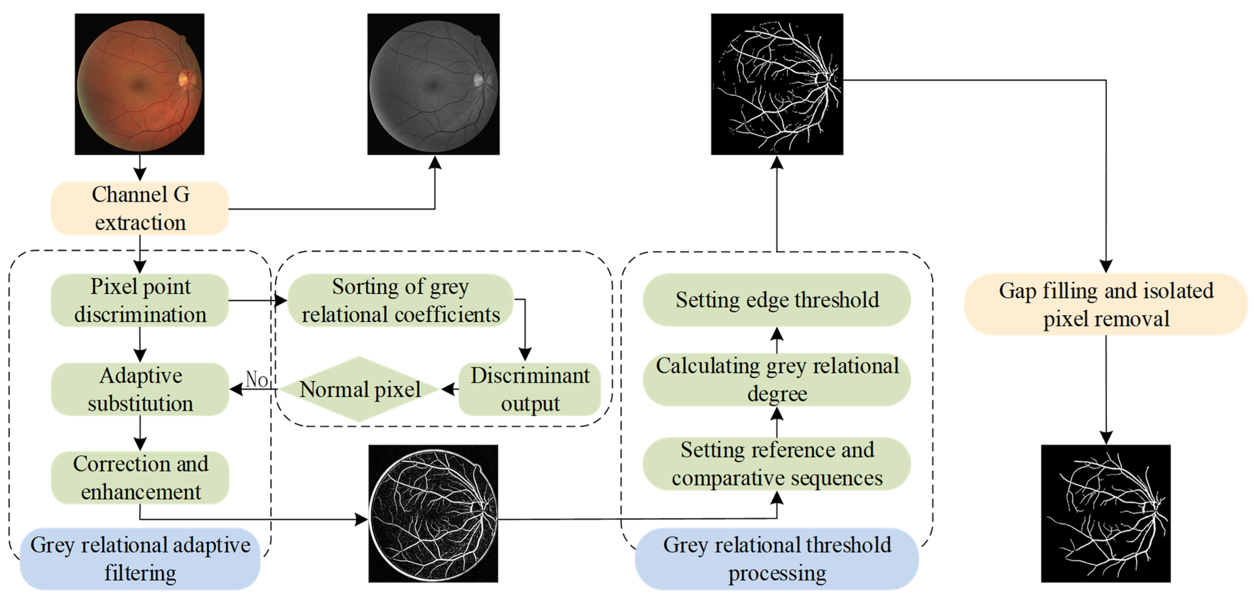 A Novel Single-Sample Retinal Vessel Segmentation Method Based on Grey ...