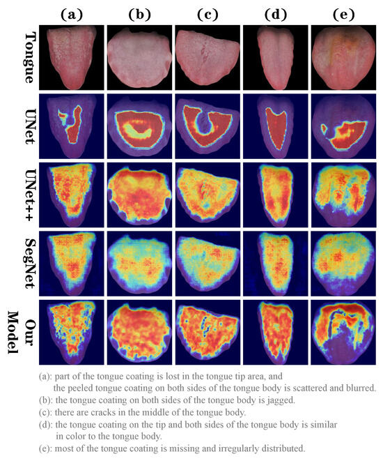 A Novel Tongue Coating Segmentation Method Based on Improved TransUNet