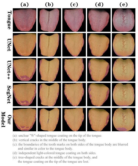 A Novel Tongue Coating Segmentation Method Based on Improved TransUNet