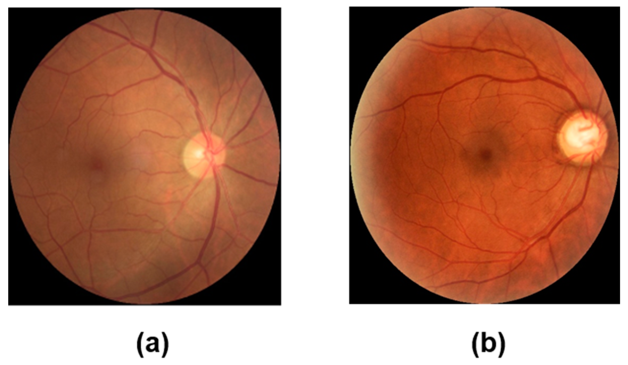 Attention Mechanism-Based Glaucoma Classification Model Using Retinal Fundus Images