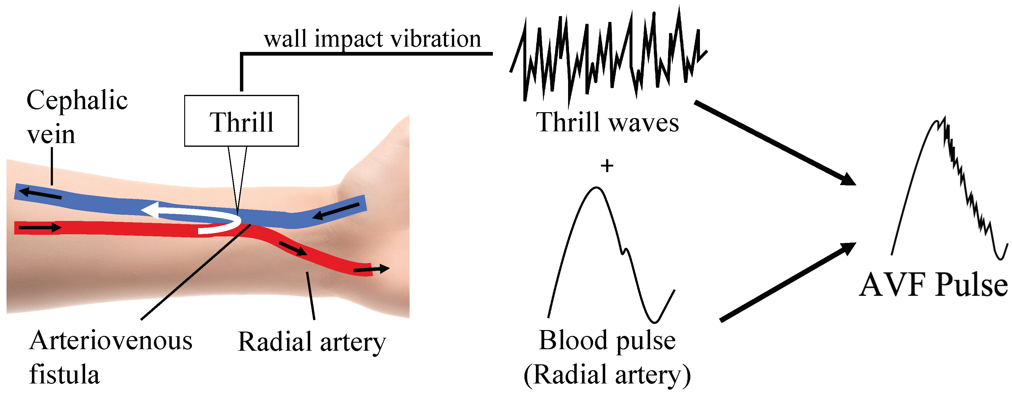 Reliable Stenosis Detection Based on Thrill Waveform Analysis Using Non-Contact Arteriovenous ...