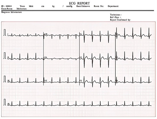 A Novel Real-Time Detection and Classification Method for ECG Signal ...