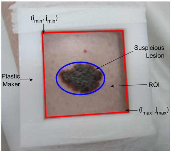 Feasibility Study on the Use of Infrared Cameras for Skin Cancer ...
