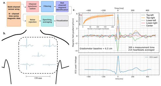 Bedside Magnetocardiography with a Scalar Sensor Array