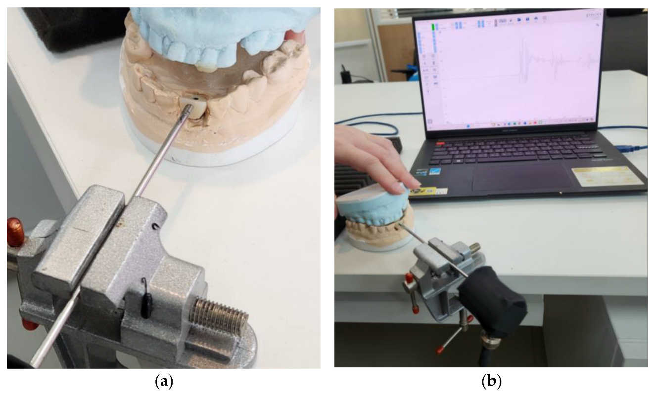 Automated Crack Detection in Monolithic Zirconia Crowns Using Acoustic ...
