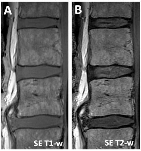 Ultrashort-Echo-Time MRI of the Disco-Vertebral Junction: Modulation of ...
