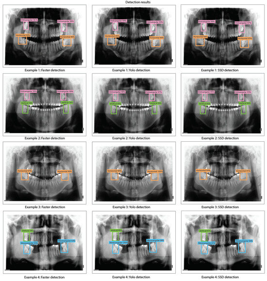 Comparison of Faster R-CNN, YOLO, and SSD for Third Molar Angle Detection in Dental Panoramic X-rays