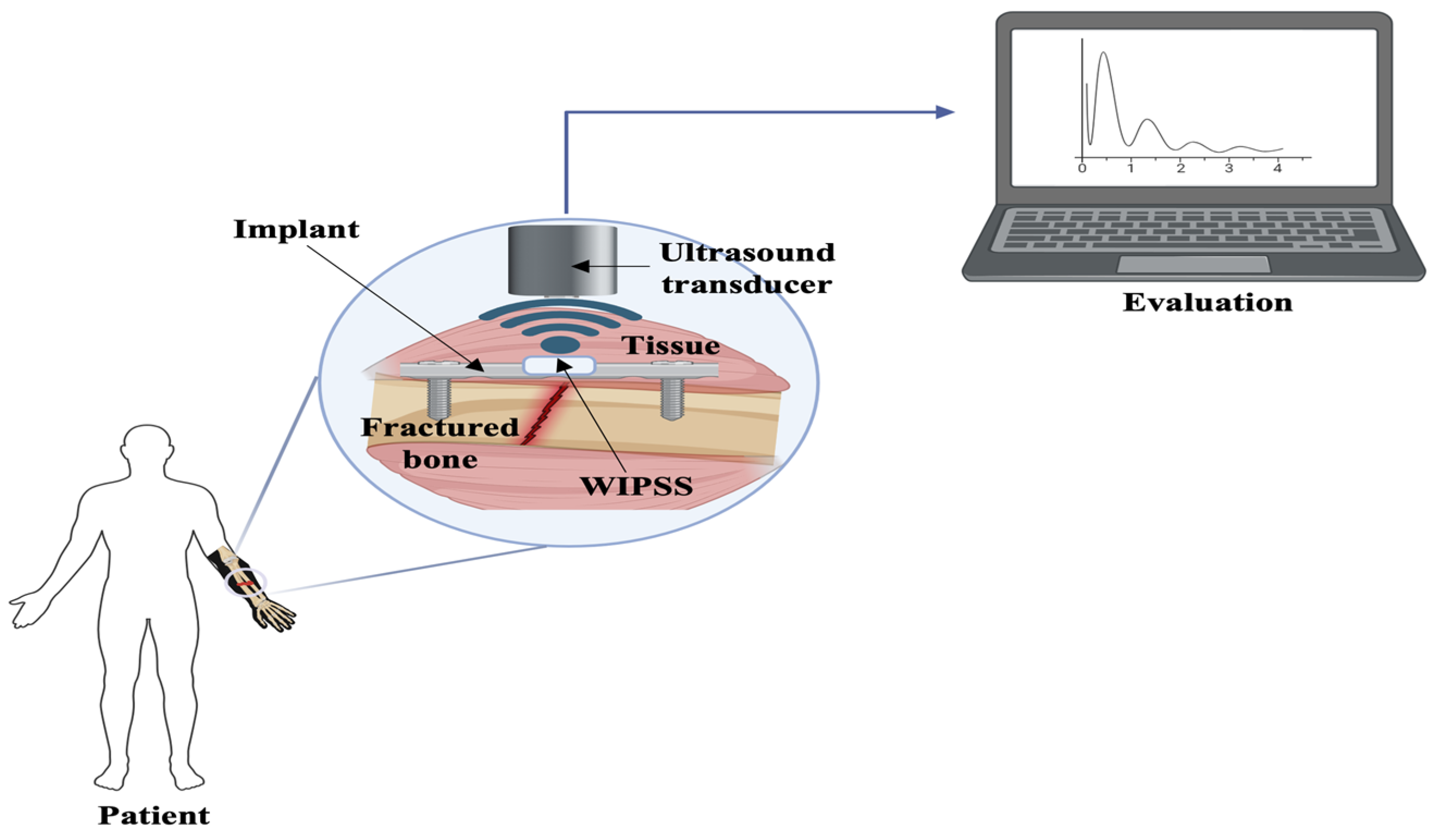 Sensors in Bone: Technologies, Applications, and Future Directions