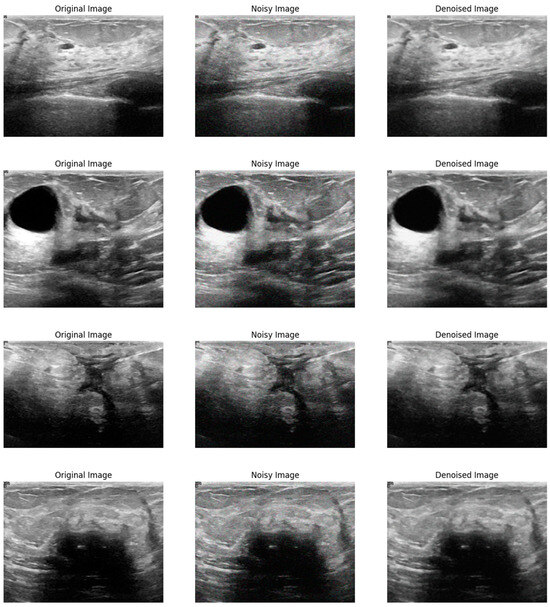 Enhanced Wavelet-Based Medical Image Denoising with Bayesian-Optimized ...