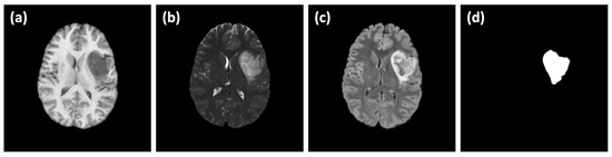 Segmentation of Low-Grade Brain Tumors Using Mutual Attention Multimodal MRI