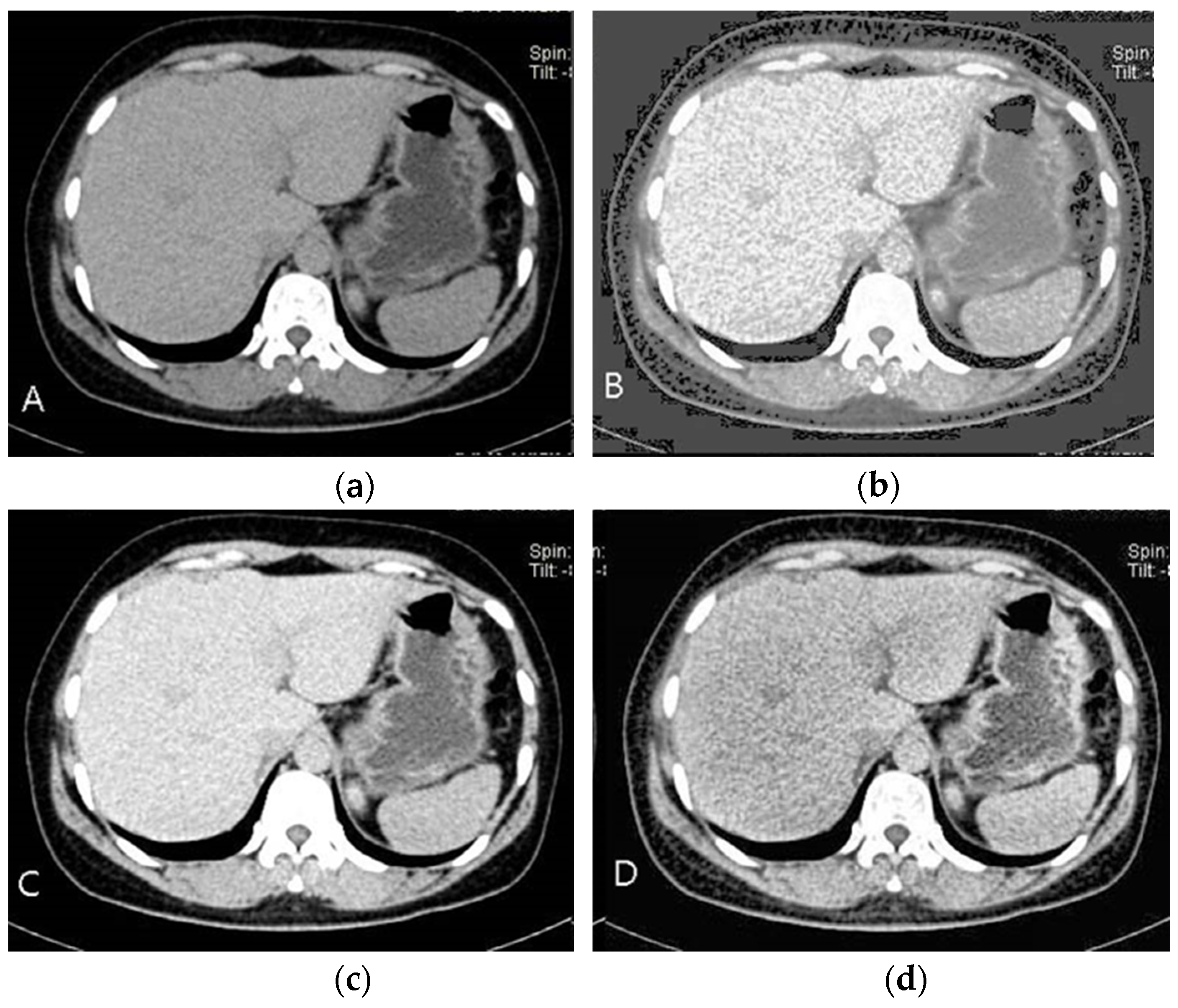 CNN-Based Kidney Segmentation Using a Modified CLAHE Algorithm