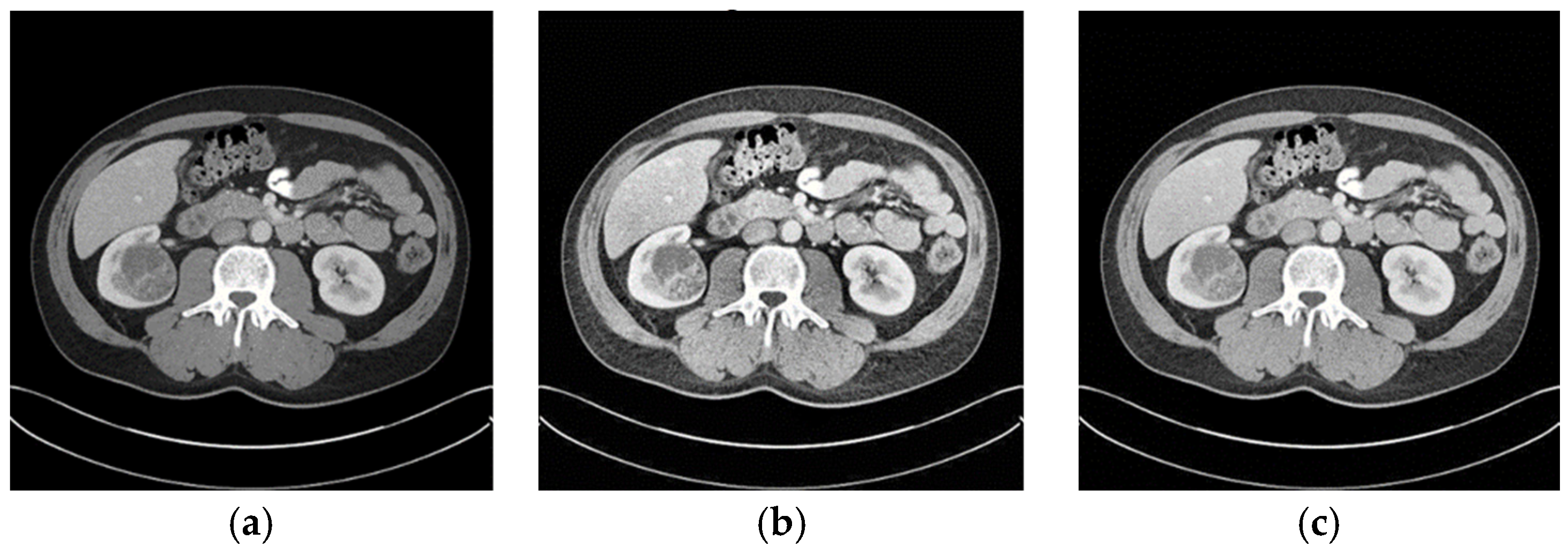 CNN-Based Kidney Segmentation Using a Modified CLAHE Algorithm