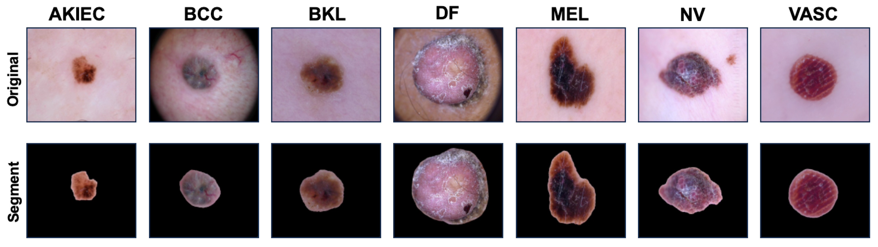 An Enhanced Approach Using AGS Network for Skin Cancer Classification